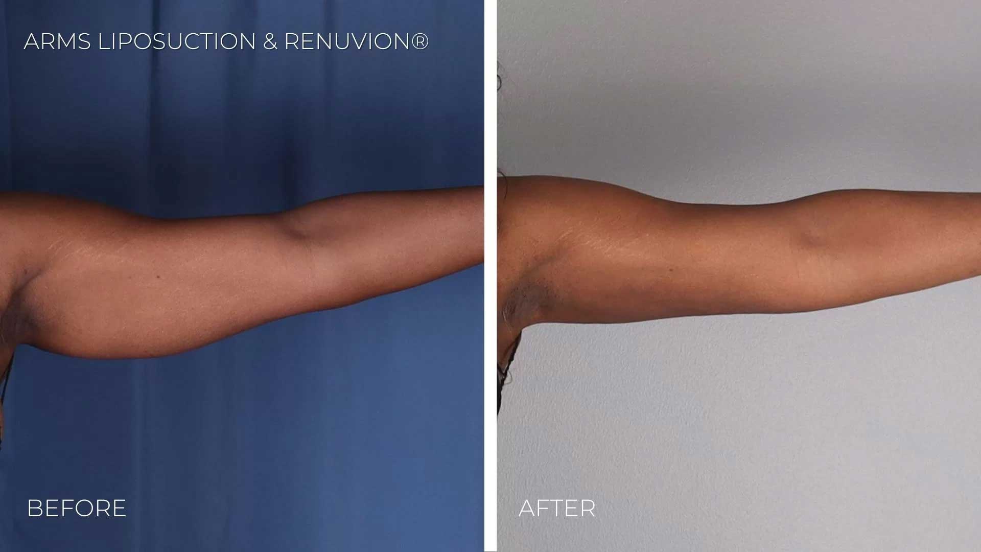 Women's Gallery | Imagen Body Sculpting